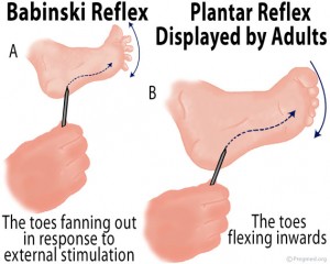 Babinski Reflex | Pregnancy Articles